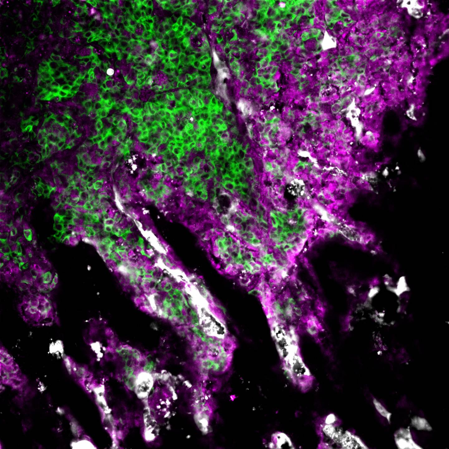 Princeton scientists discover an interaction that helps cancers spread ...